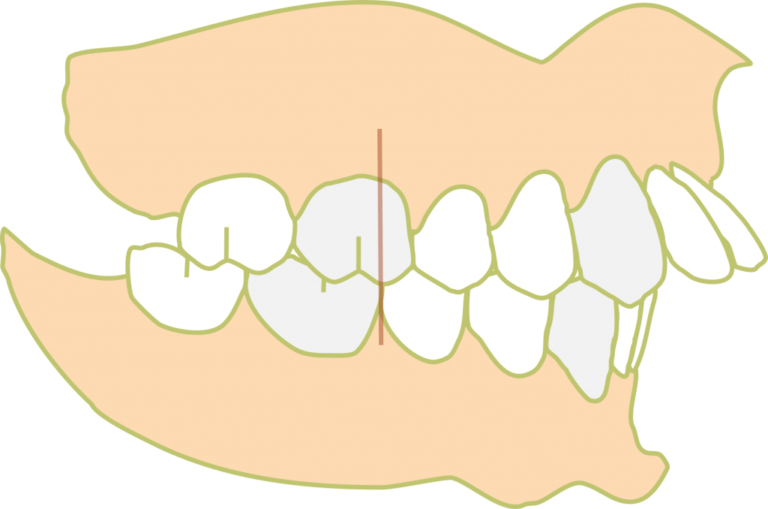 Classification Of Occlusion - Dental Panda INBDE Test Prep Courses