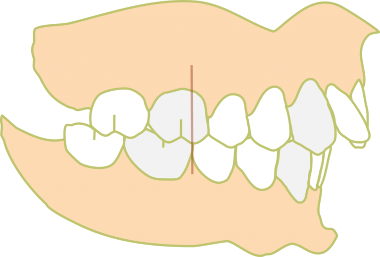 Classification Of Occlusion - Dental Panda INBDE Test Prep Courses