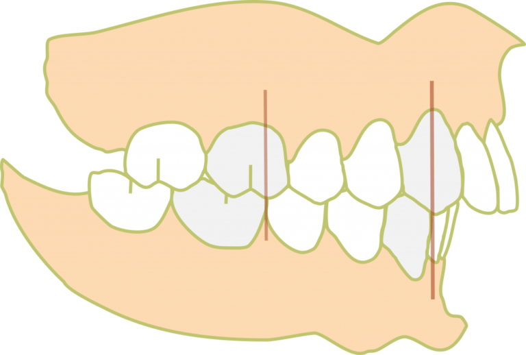 Classification Of Occlusion - Dental Panda INBDE Test Prep Courses