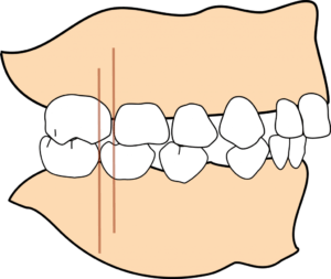 Classification Of Occlusion - Dental Panda INBDE Test Prep Courses